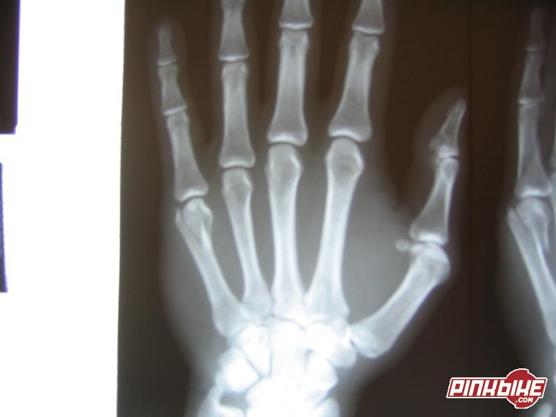 Broken hand after crash - Pinkbike