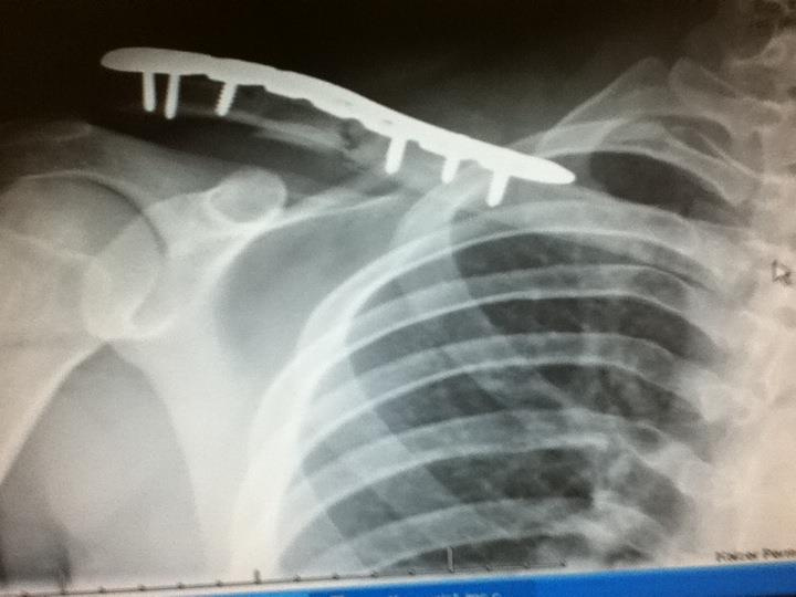 Broken Collar Bone Recovery Time - Page 24 - Pinkbike Forum