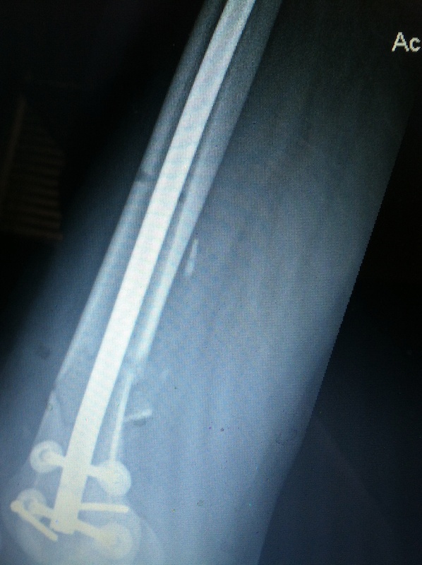 Anyone broken a femur? - Page 2 - Pinkbike Forum